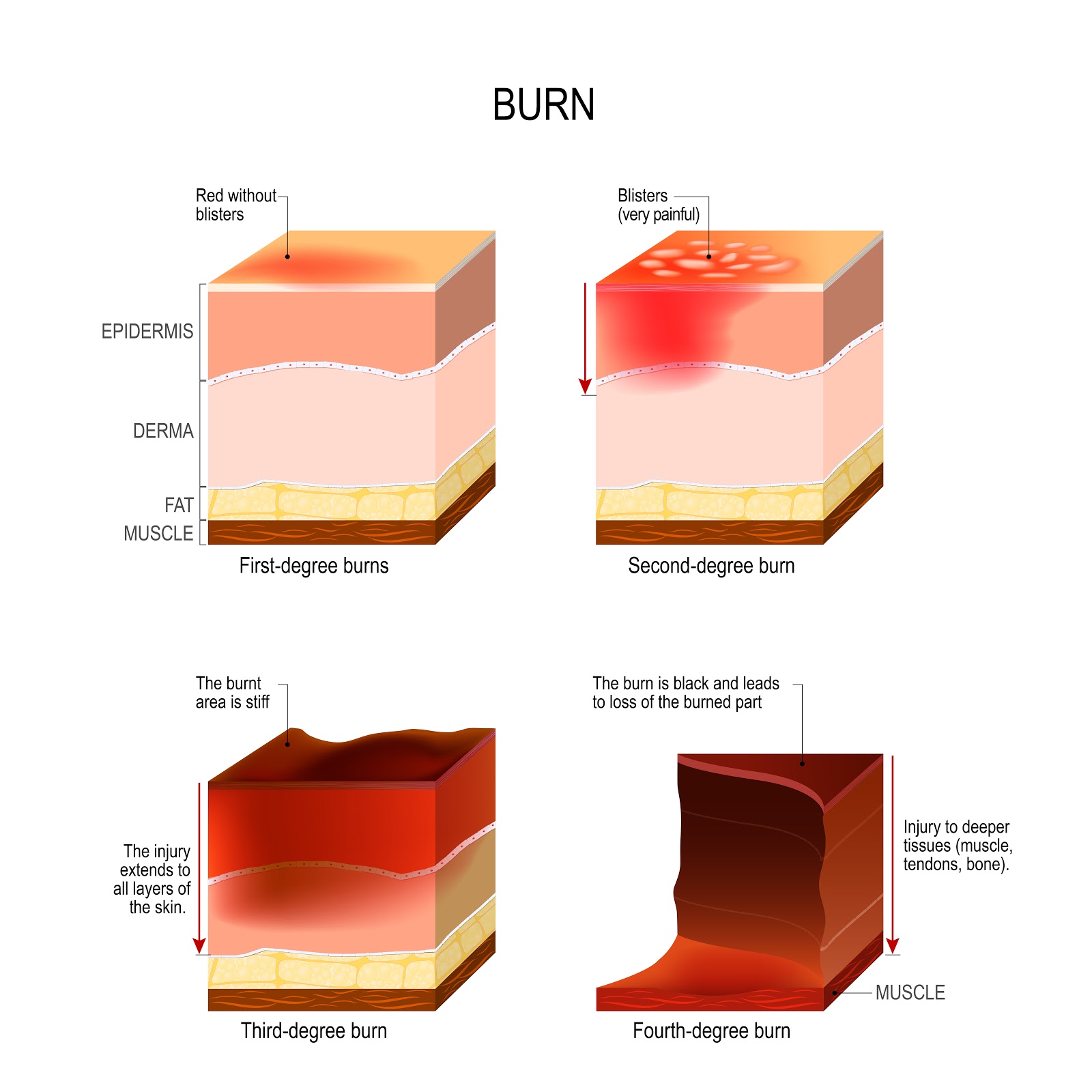 Burn Injury | Atlanta Accident Lawyers Johnson & Ward